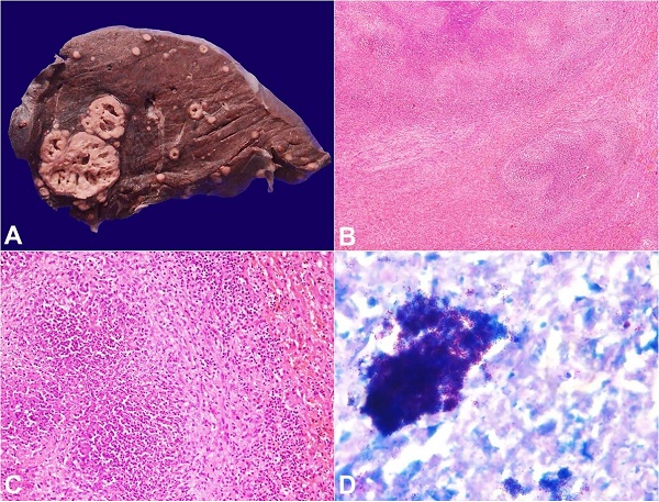 Chronic brucellosis with hepatic brucelloma and AA amyloidosis in a ...