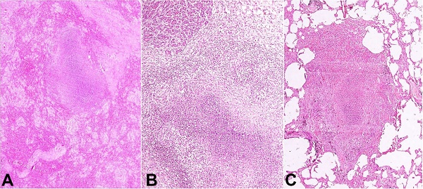 Chronic brucellosis with hepatic brucelloma and AA amyloidosis in a ...