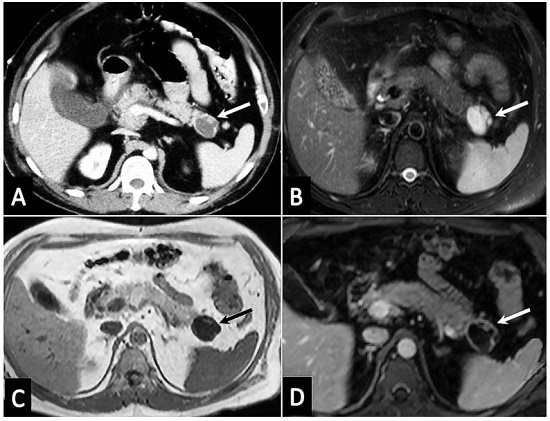 The rare case of a cystic pancreatic neuroendocrine tumor