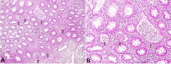 Ulcerative colitis in the postpartum period
