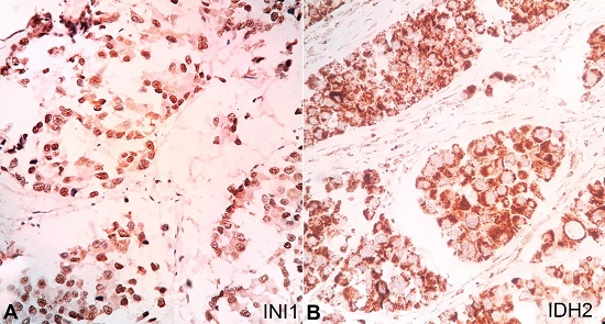 A rare presentation of Sinonasal Undifferentiated Carcinoma with brain ...