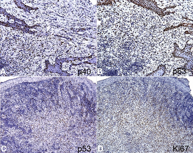 Post-radiotherapy recurrence of conventional oral squamous cell ...
