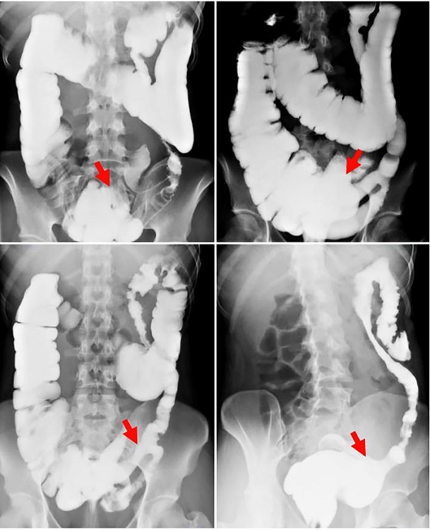 Tubular colonic duplication in an adult patient with long-standing ...