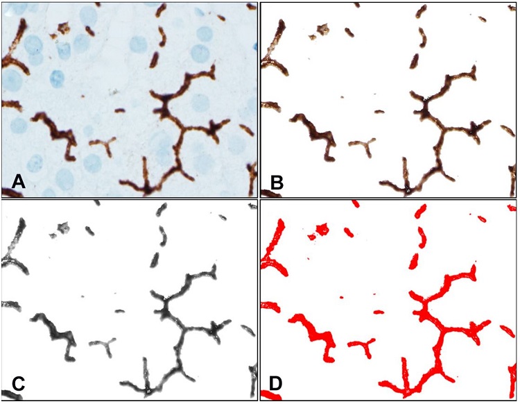 Histomorphometric analysis of liver biopsies of treated patients with ...