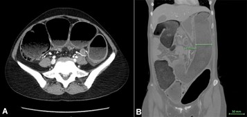 Rectal endometriosis presenting as toxic megacolon