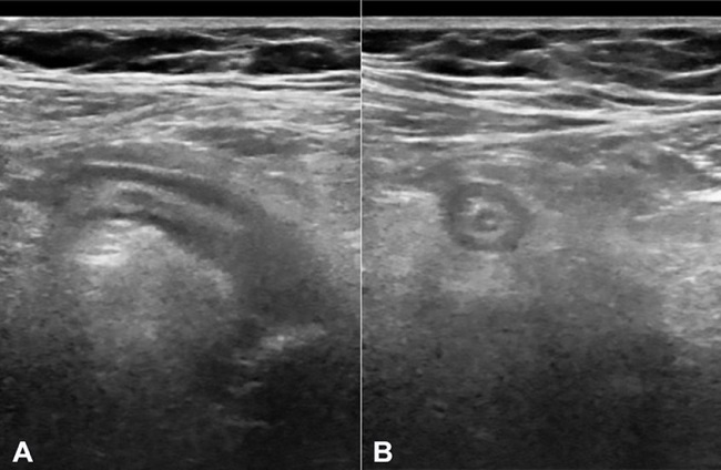 Mucinous adenocarcinoma of the appendix with inguinal node metastases