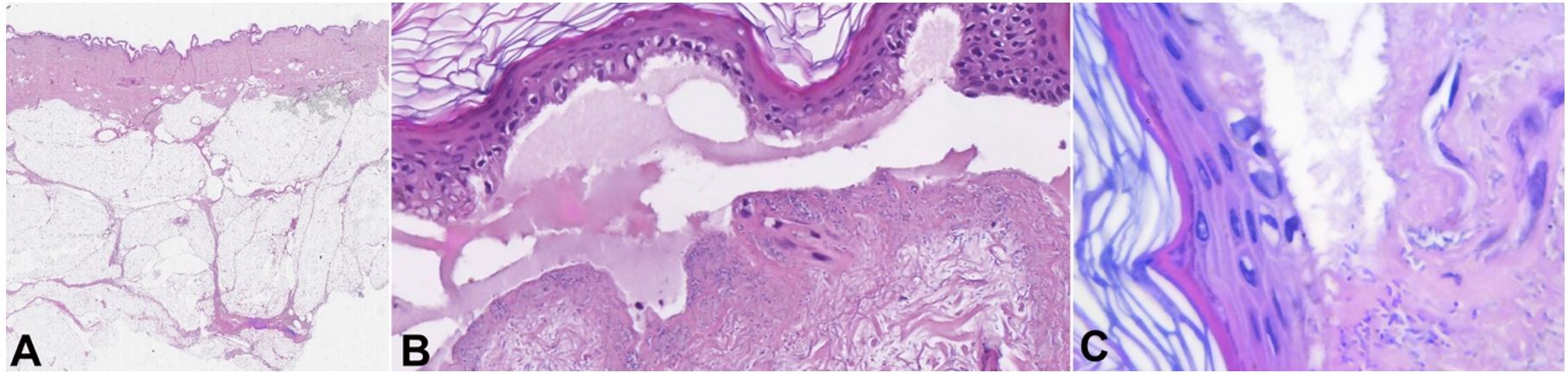 Primary abdominal gas gangrene: a report of two autopsy cases
