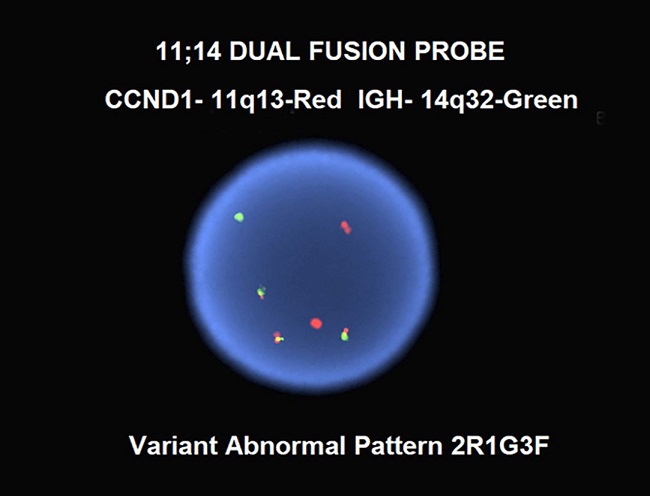 Mantle cell lymphoma presenting with lethal atraumatic splenic rupture