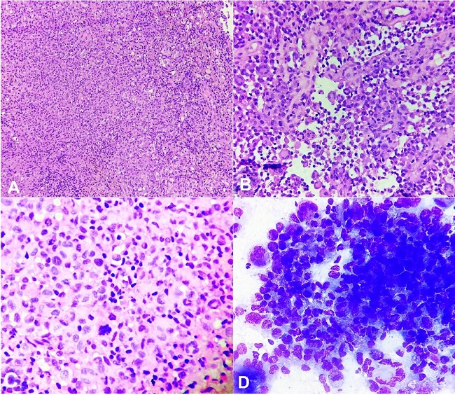 Nodal Langerhans cell neoplasm: detailing the diagnostic quandaries