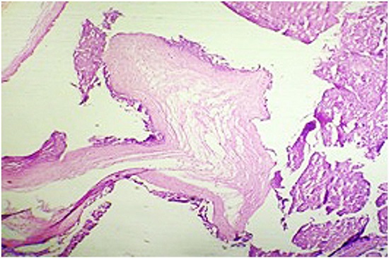 Complete hydatidiform mole with a twin pregnancy at 26 weeks: a rare ...
