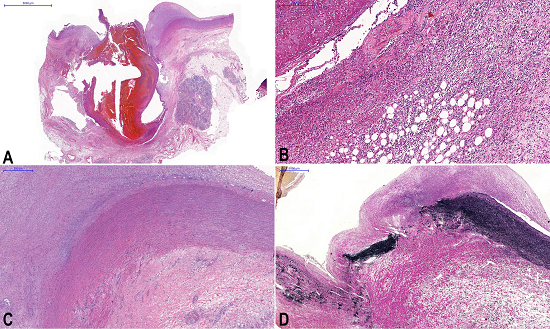 Mycotic aneurysm with aortoduodenal fistula