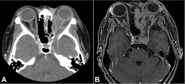 Loss of an eye to mucormycosis following corticosteroid therapy for ...