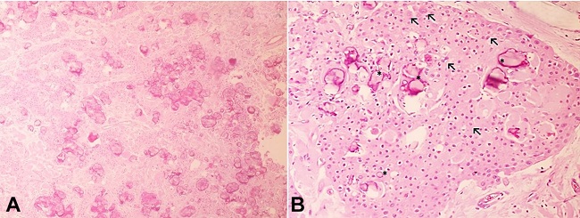 Pindborg tumor associated with a supernumerary tooth: a case report