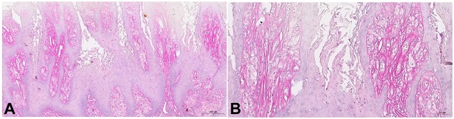 Verruciform xanthoma associated with lichen planus