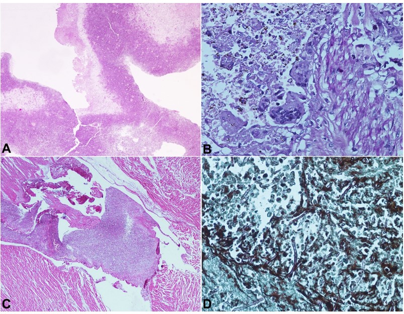 Dual pathogen valvular endocarditis in a case of severe aortic aneurysm