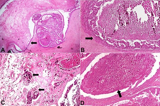 Invasive cystic hypersecretory carcinoma of the breast