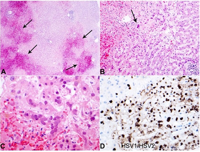 Fulminating herpes simplex hepatitis