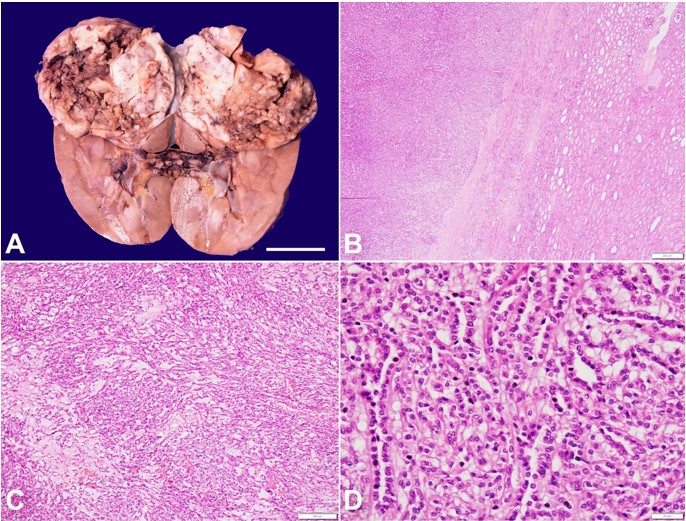 Mucinous tubular and spindle cell carcinoma of the kidney