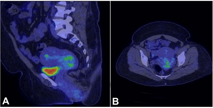 Embryonal rhabdomyosarcoma of the uterine cervix in an adult female