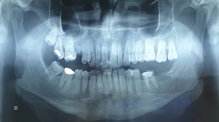 Rosai-Dorfman disease of the oral cavity
