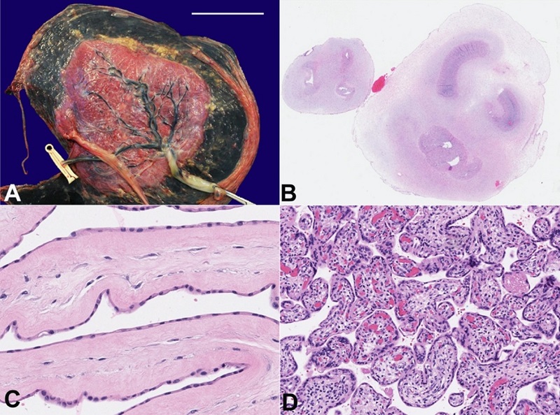 Novel autopsy and genetic findings in an acardiac twin: case report and ...