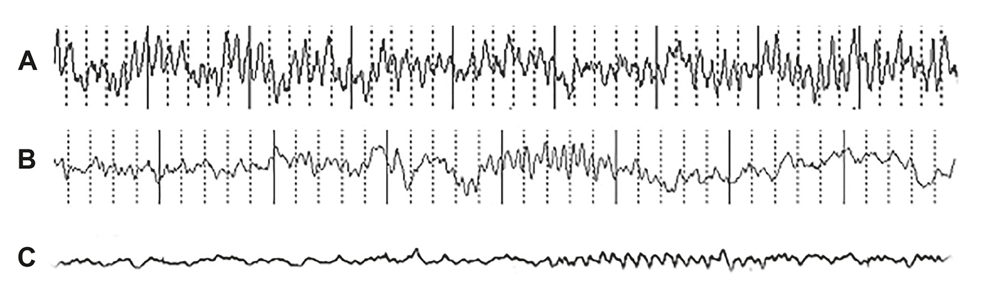 Characterization of the Mu rhythm during the sleep of children with ...
