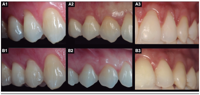 Association between platelet-rich fibrin and collagen matrix for root ...
