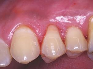 Use of cyanoacrylate for the stabilization of tissues in root coverage ...