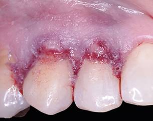 Use of cyanoacrylate for the stabilization of tissues in root coverage ...