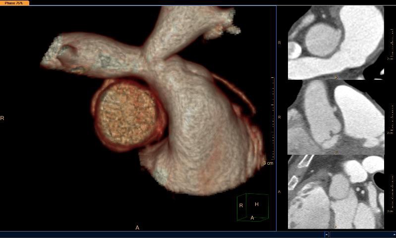 Initial experience with Edwards SAPIEN valve transcatheter implantation ...