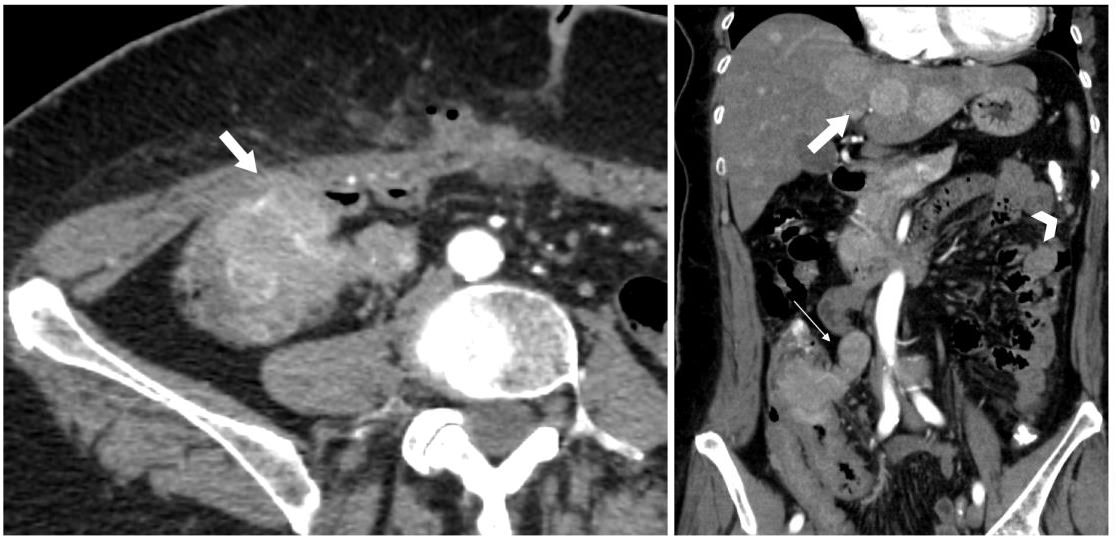 High-grade well-differentiated neuroendocrine tumour of the cecum ...