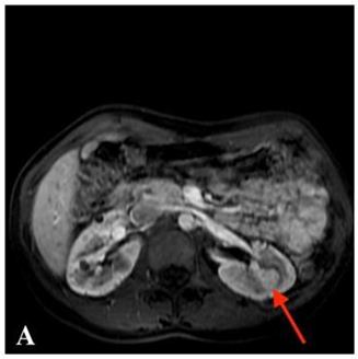 Von Hippel-Lindau syndrome and renal tumours: radiological diagnostic ...
