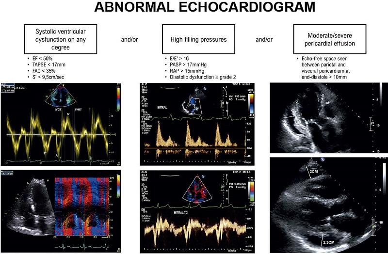 Echocardiogram in Critically ill Patients with COVID-19: ECOVID Study