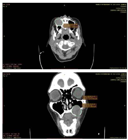 Residual cyst with semisolid content, a clinical case