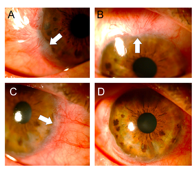 Severe corneal burn due to the accidental application of salicylic acid ...
