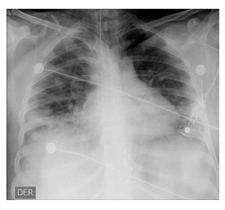 Coinfección por SARS-CoV-2 y rinovirus-enterovirus en una paciente ...
