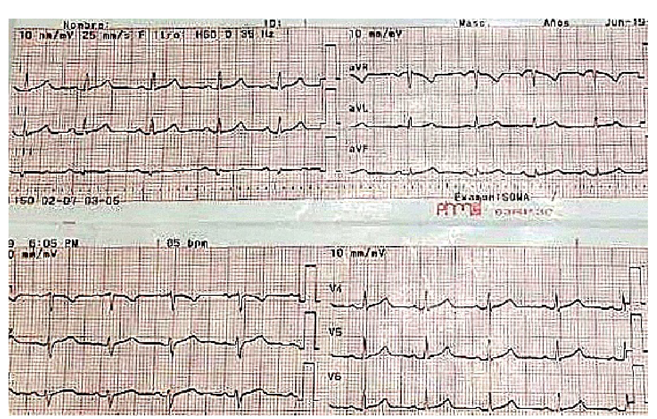 Intoxicación escombroide secundaria al consumo de atún: presentación de ...