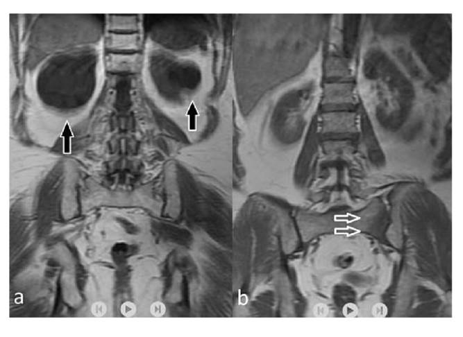 Added value of coronal-T1 W sequence to the lumbar MR imaging protocol for low back pain