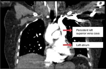 Persistent left superior vena cava as an incidental fnding in the ...